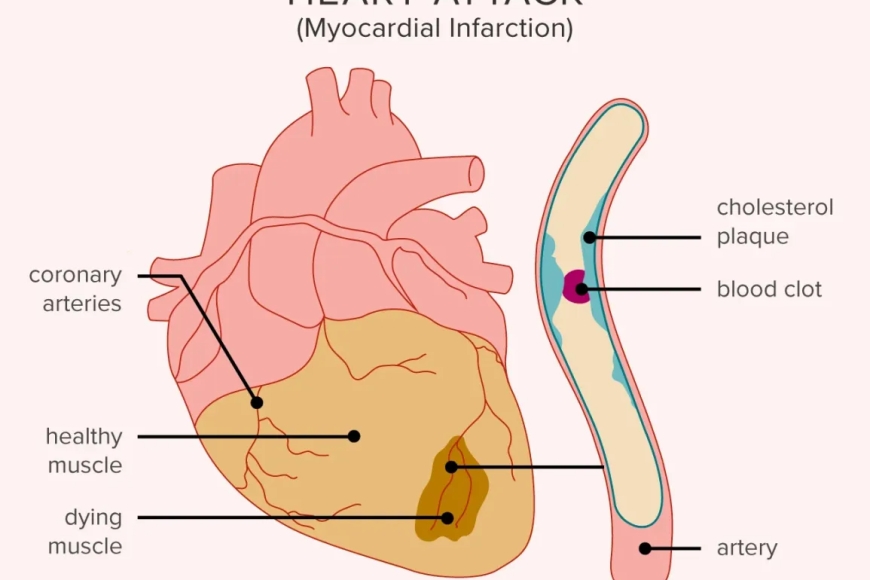 Introduction To Heart Attack For Kids - Khichdi Network Portal