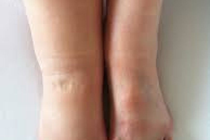 Lymphedema - Khichdi Network Portal Lymphedema - Khichdi Network Portal