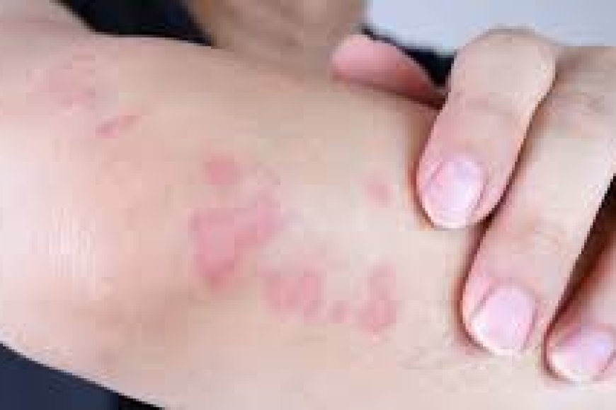 Vasculitis - Khichdi Network Portal Vasculitis - Khichdi Network Portal